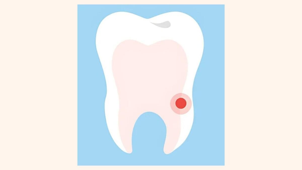 What Does a Cavity Look Like? Recognizing the Signs Stages and ...