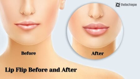What Is a Lip Flip? Types, Benefits, Procedure, and Side Effects ...